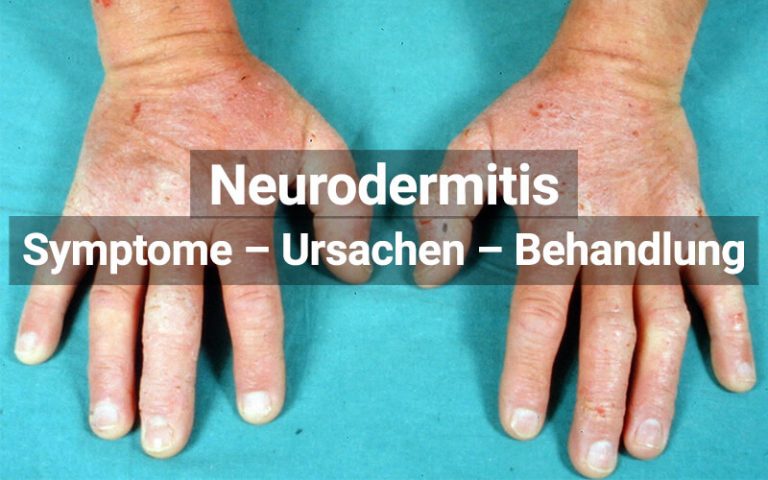 Neurodermitis: Symptome, Ursachen, Therapie | praktischArzt